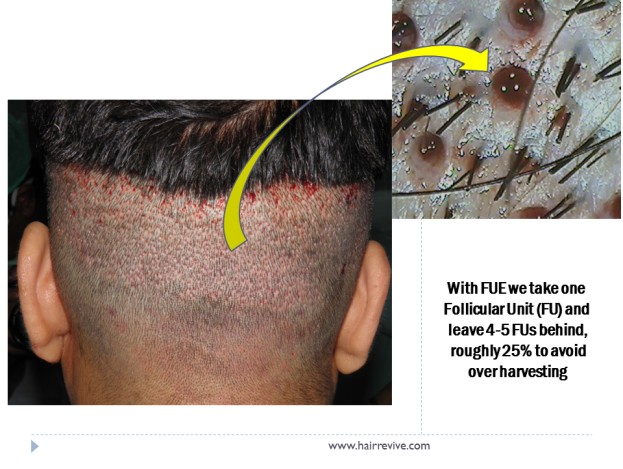 Follicular Unit Extraction (FUE) – Hairrevive