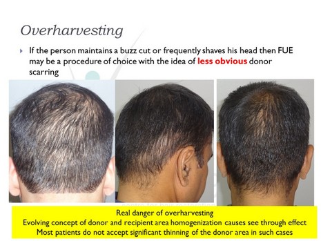 Follicular Unit Extraction (FUE) – Hairrevive