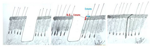 Follicular Unit Transplantation (FUT) – Hairrevive